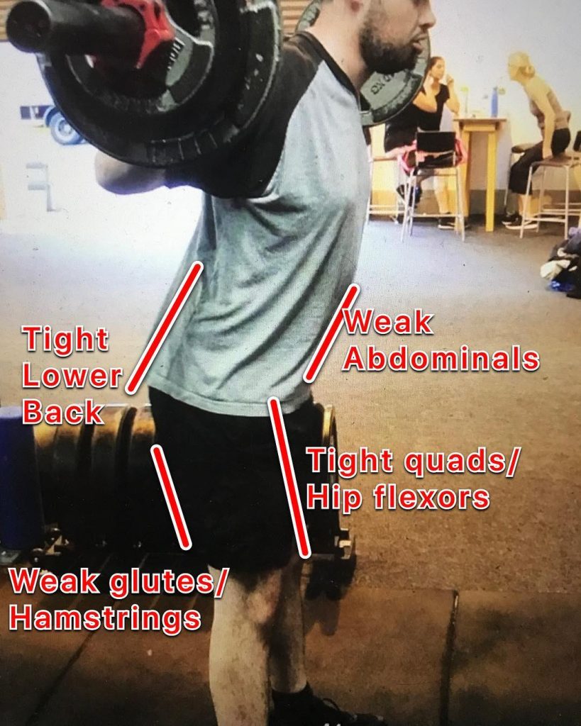 Causes of Anterior Pelvic Tilt (APT) - Wellman Fitness